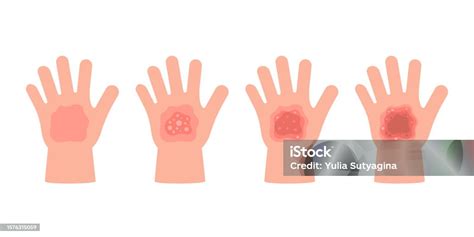 손의 화상 아이 피부가 다른 정도 화재 또는 화학적 부상 피부에 대한 응급 처치 시각적 증상 화상 벡터 건강관리와 의술에 대한