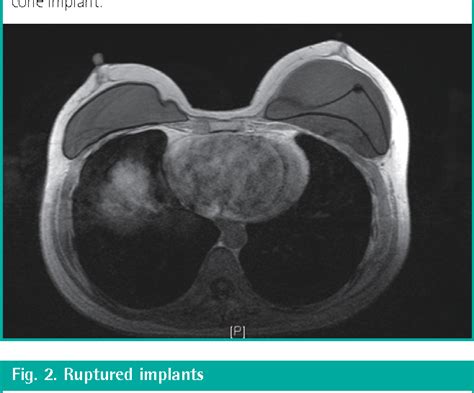 Figure 1 From A Retrospective Analysis Of Ruptured Breast Implants