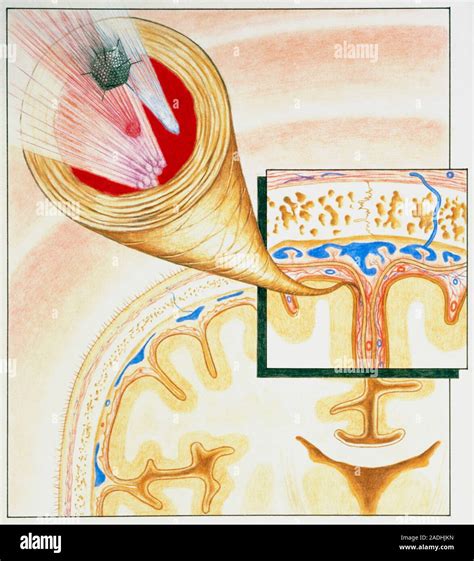 Ilustración Que Representa El Inicio De La Meningitis La Meningitis Es