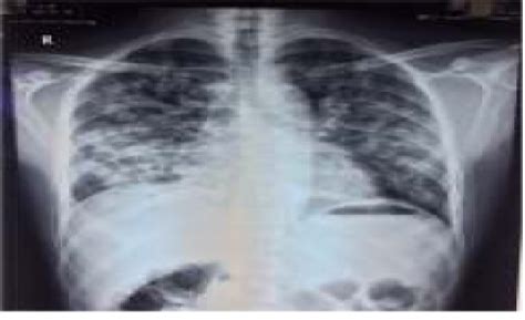 Chest X Ray Pa View Showing Right Side Pleural Effusion With Nodular