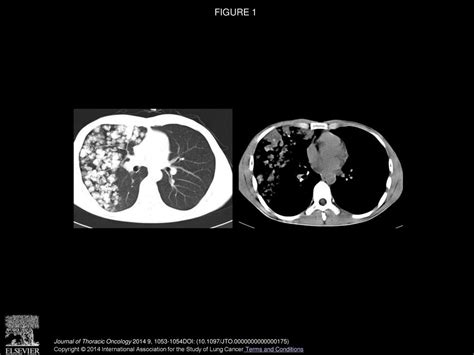 Multiple Pulmonary Chondroid Hamartoma Ppt Download