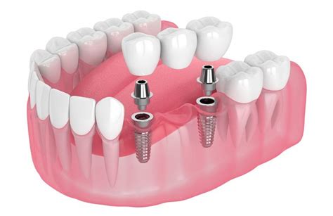 Removable Dental Implants Artistic Dentistry