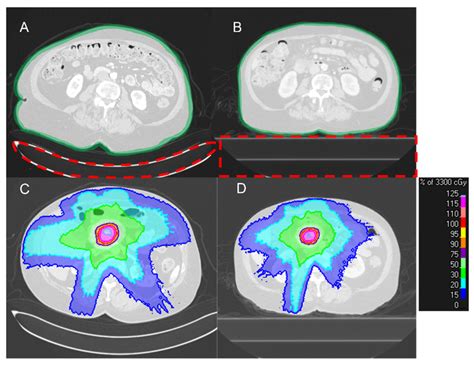 A Typical Dct A And Pct B Pair From A Patient A The Difference Download Scientific