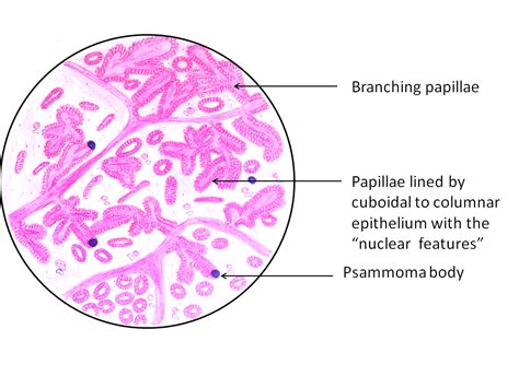 Papillary Carcinoma Thyroid Pathology Made Simple