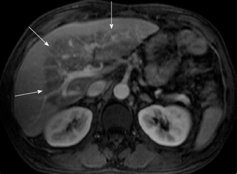 Spoiled Gradient Recalled Echo And Fat Suppressed T1 Weighted Magnetic Download Scientific