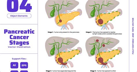 Pancreatic Cancer Pancreas Tumor Growth Stages Illustrations Ft