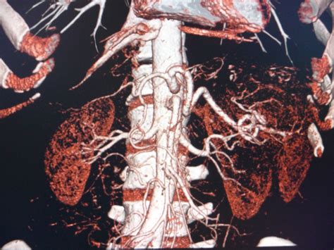 Renal Artery Arteriogram Southern African Endourology Society