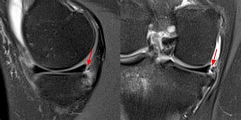 Meniscal Tear Patterns In Acl Disruption Radsource