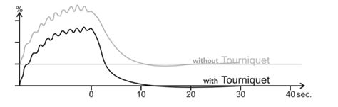 D Ppg Muscle Pump Test Venous Reflux Vascular Academy Powered By Sot