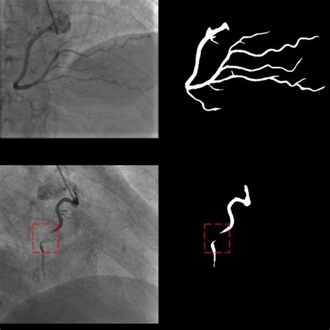 Examples Of Two X Ray Images And Their Segmentation Results Depicting