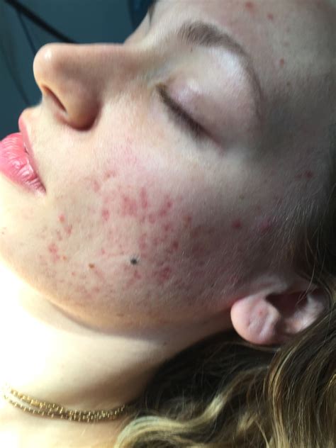 Boxcar Rolling And Icepick Scars Acne Scar Types And Treatments