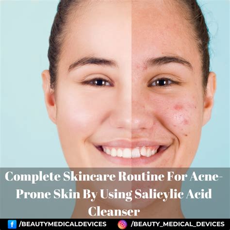 Skincare Routine For Acne Prone Skin By Using Salicylic Acid