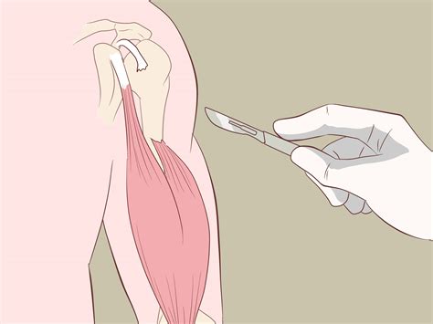 Easy Ways To Treat Bicep Tendonitis Steps With Pictures