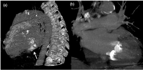 Volume Rendered Ct Image A Shows The Caseous Calcification In The