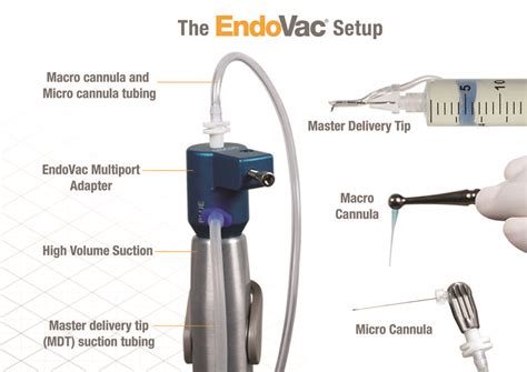 Safe And Effective 3 D Endodontic Disinfection Laser Assisted Endodontic Irrigation Oral