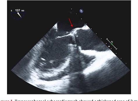 Figure 2 From Diagnostic Challenge Of Annular Abscess In A Patient With
