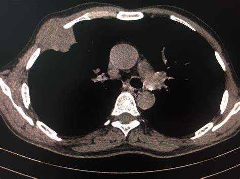 Soft Tissue Mass With Rib Erosion Artofit