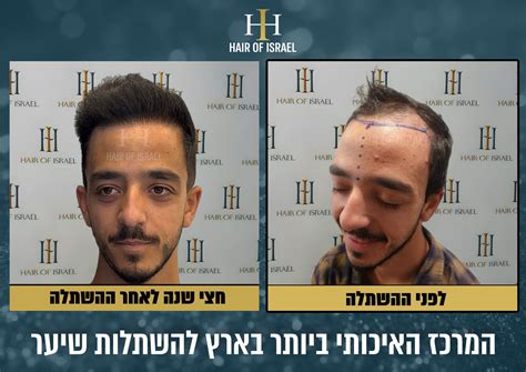 עמוד הבית Hair Of Israel השתלות שיער בישראל השיטה הטורקית