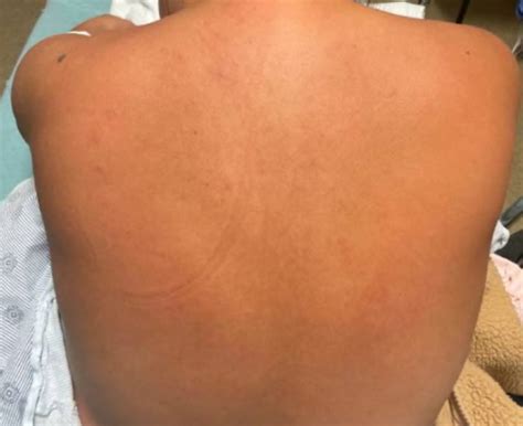 A Case Report On Dermatomyositis In A Female Patient With Facial Rash