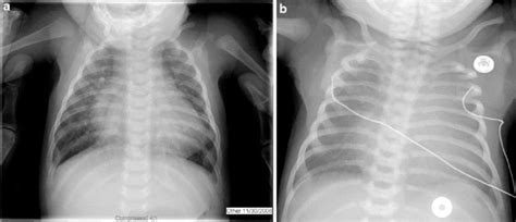 6 Examples Of Increased Pulmonary Lung Water Leading To Decreased