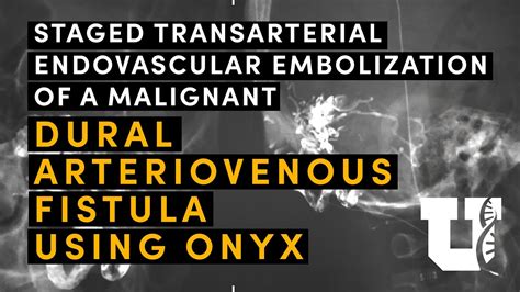 Staged Transarterial Endovascular Embolization Of A Malignant Dural Arteriovenous Fistula Using