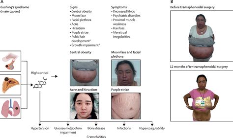 Cushings Syndrome Cushing Disease Cushing Syndrome Brain Institute