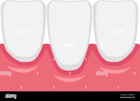 Vector Illustration Of Gingival Recession Stock Vector Image And Art Alamy