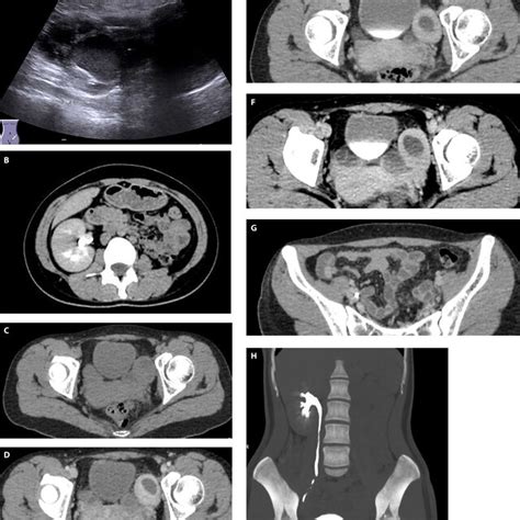 Aultrasound Of The Left Side Of The Pelvis Showed A Substantial