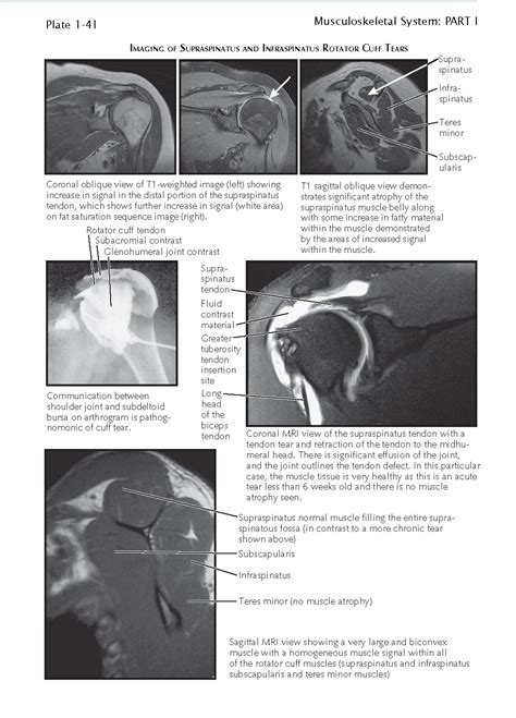 Imaging Of Supraspinatus And Infraspinatus Rotator Cuff Tears
