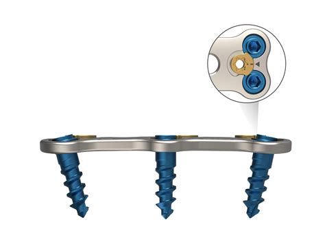 Anterior Cervical Plate Baui Biotech