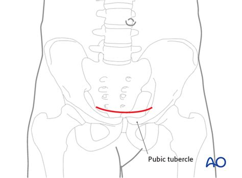 Pubic Tubercle