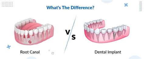 Root Canal Vs Dental Implant Whats The Difference La Dental Clinic