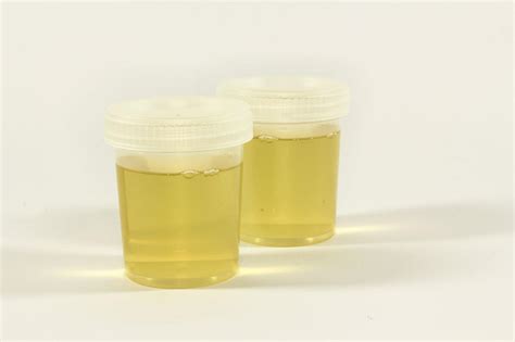 OsmolaritÉ Urinaire Quest Ce Que Cest À Quoi Ça Sert Calcul