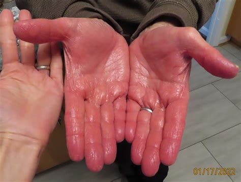 Figure 5 The Patient S Hands 5 Months After Diagnosis With His Wife S