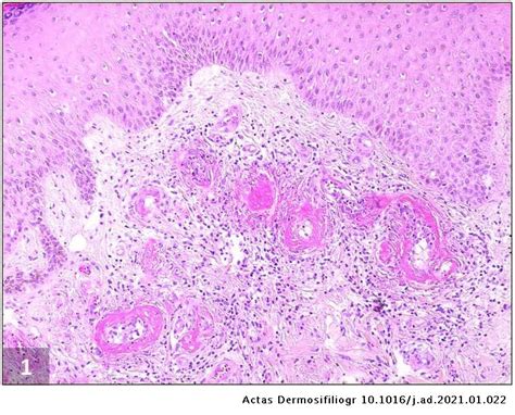 Livedoid Vasculopathy Associated With Plasminogen Activator Inhibitor 1 Polymorphisms Treated