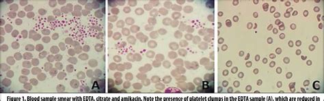 Figure 1 From Pseudothrombocytopenia Induced By Edta And Chronic