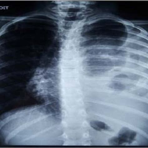 Chest X Ray P A View Showing High Density Opacities Occupying