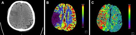 A Ct Scan Showing Right Mca Hypodensity B And C Ct Perfusion Scan Download Scientific