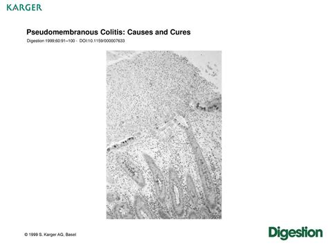Pseudomembranous Colitis Causes And Cures Ppt Download