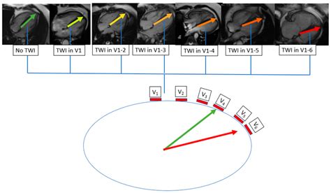Graphical Representation Of Right Ventricle Dislocation Towards Lead V6