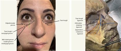 Restoring Youth To The Upper Midface By Blending The Lid Cheek Junction