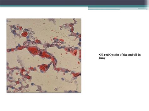 Lipid Staining New Slideshare Which Help Pptx