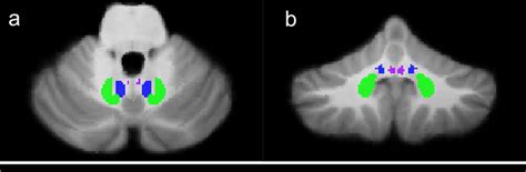 Regions Of Interest In Deep Cerebellar Nuclei The Bilateral Dentate