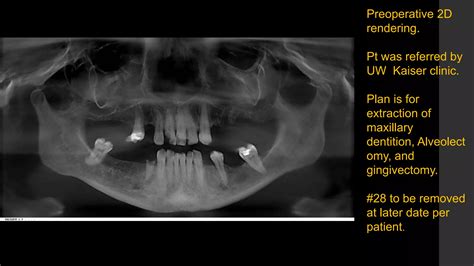 Extraction Of Maxillary Anterior Dentition Alveolectomy Gingivectomy