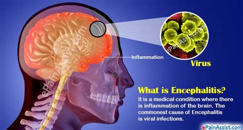 Encephalitis Causes Symptoms Treatment Complications Diagnosis Risk