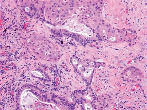 Malignant Lung Neoplasms Thoracic Key