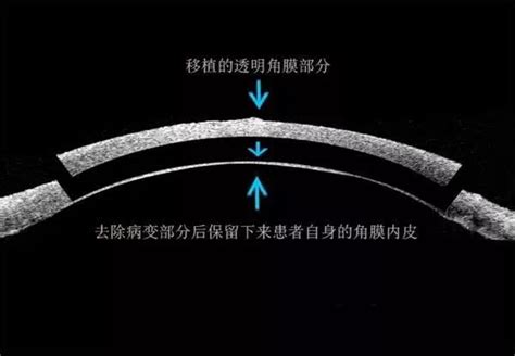 角膜移植手术是怎么实施的小编带你全程揭秘
