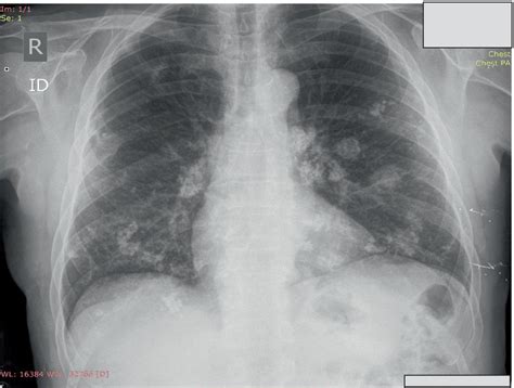 Chest X‐ray At The Admission In The Pulmonary Clinic With Many Diffuse Download Scientific