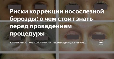 Риски коррекции носослезной борозды о чем стоит знать перед