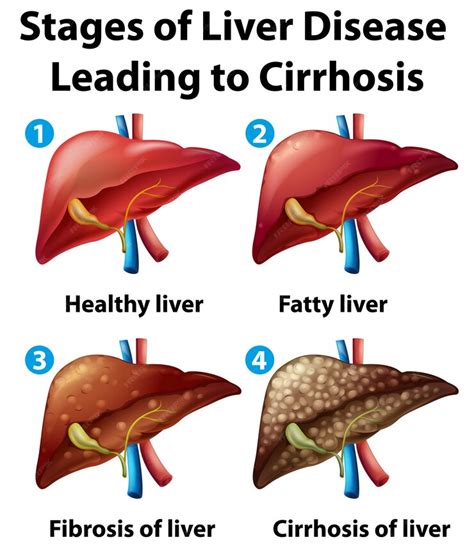 Free Vector Stages Of Liver Disease Leading To Cirrhosis